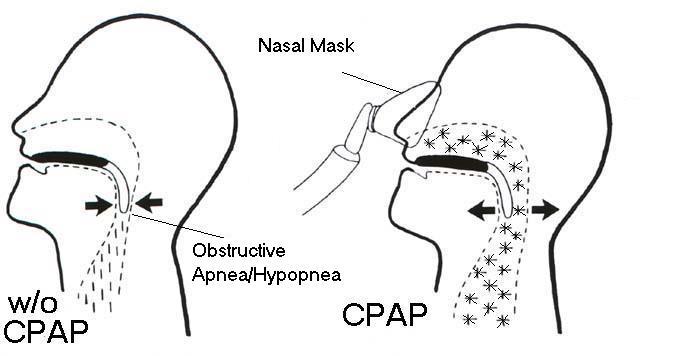 Link-how-cpap-works – Curaflow
